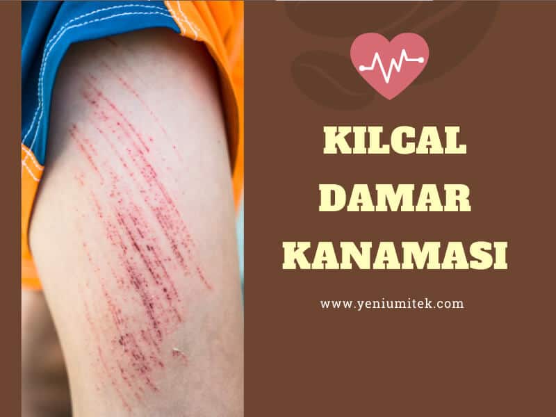 Kılcal Damar Kanaması Nasıl Olur? - Yeni Ümit Eğitim Kurumları